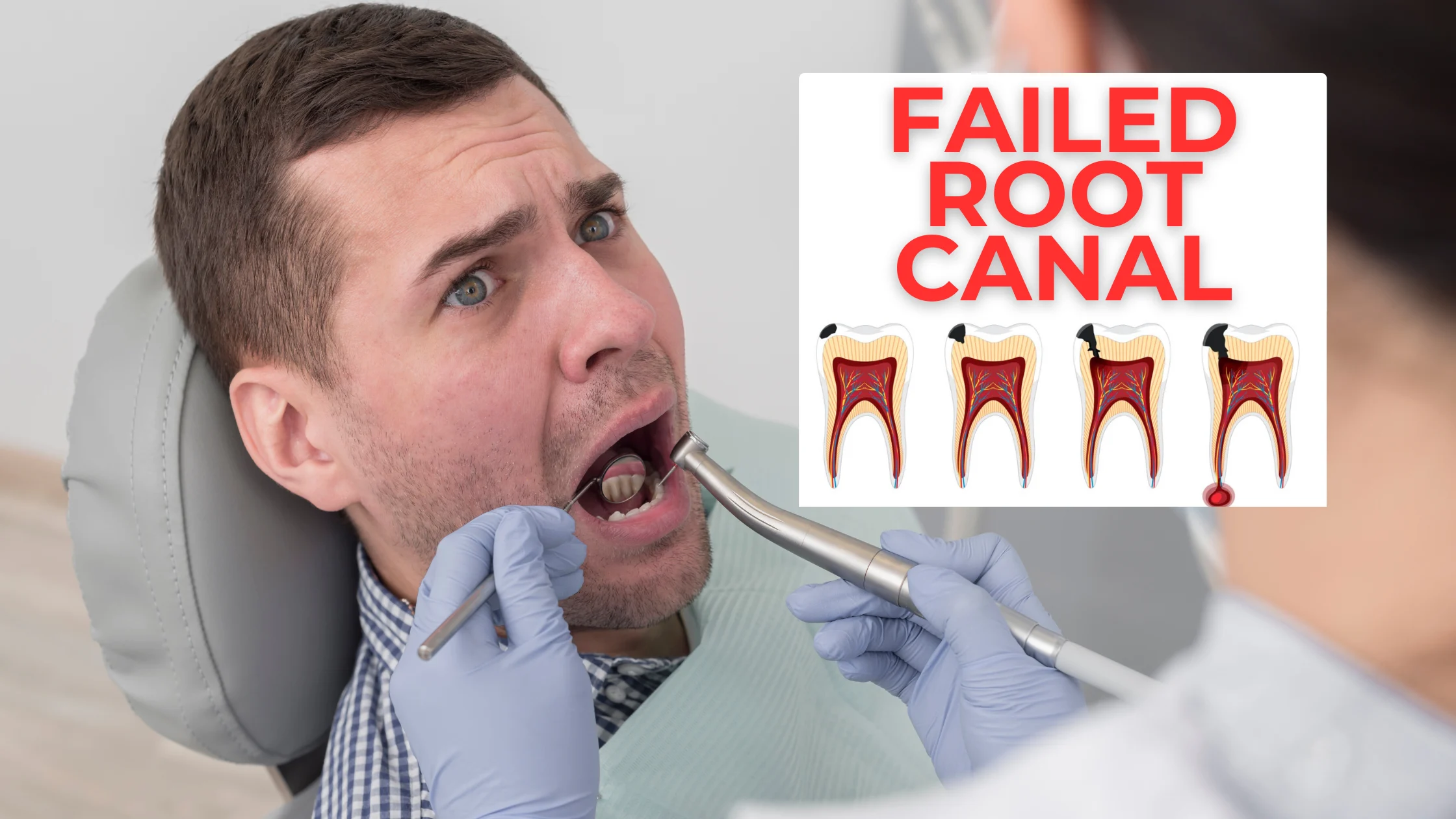 Symptoms of a Failed Root Canal: What to Watch For